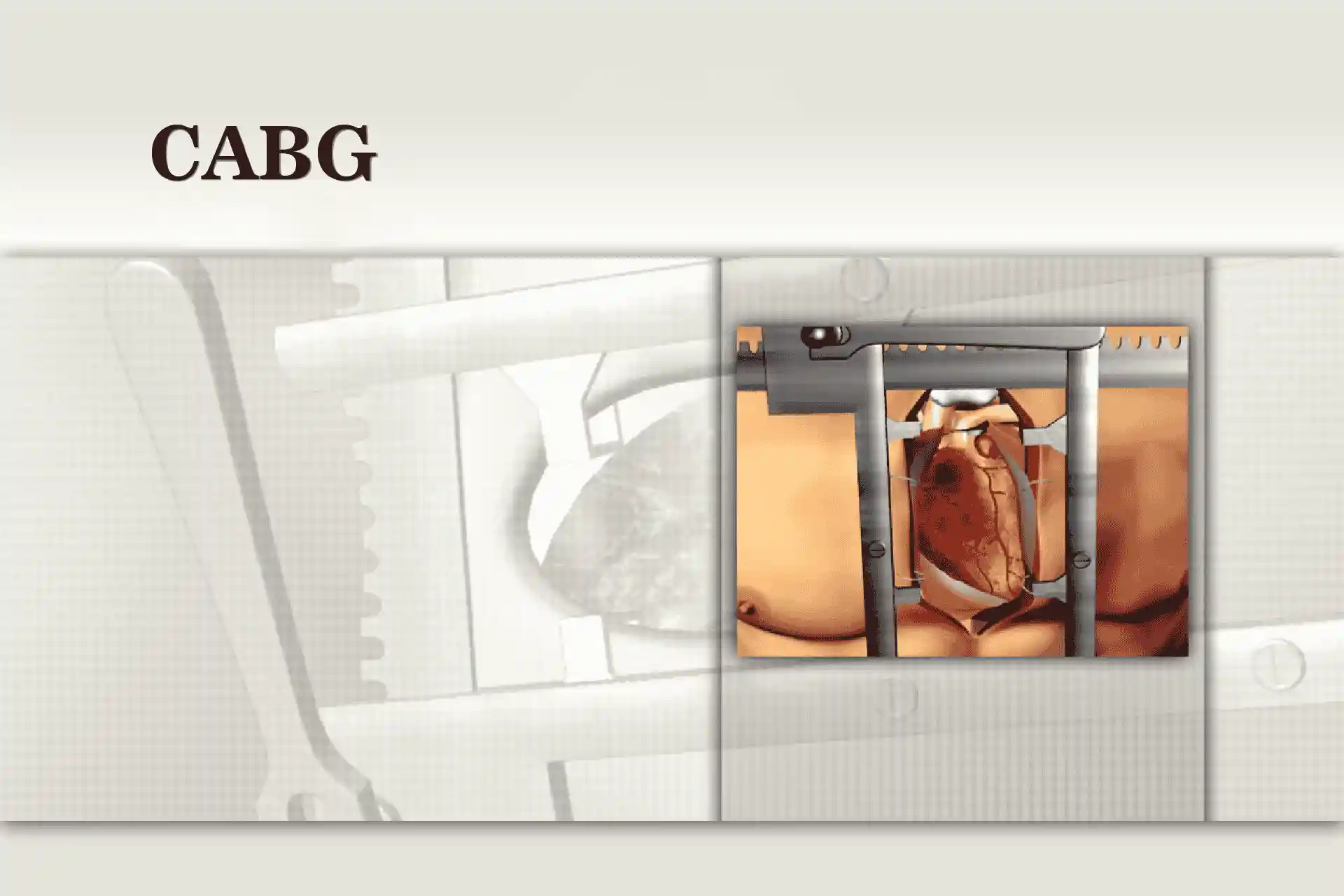 Coronary Artery Bypass Graft (CABG)